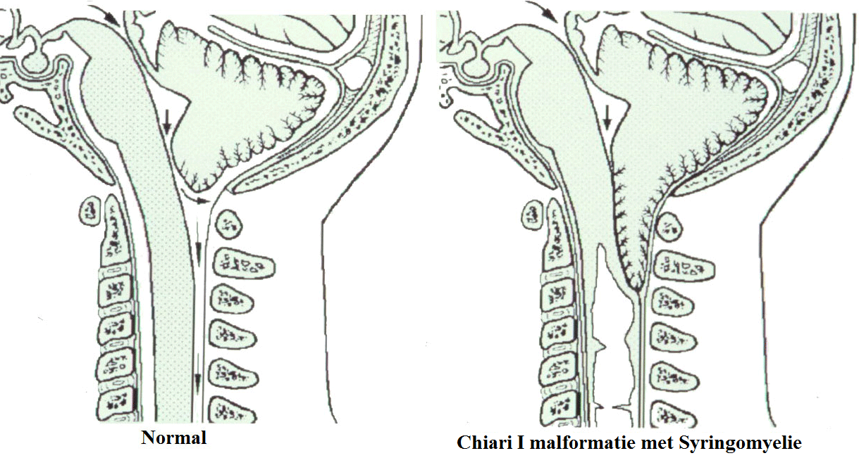 chari_malformatie_nl – Clínica Neuros | Neurocirujano Valencia